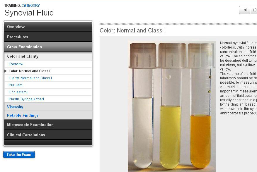 Synovial Fluid Sample Screens Synovial Fluid Sample Screens
